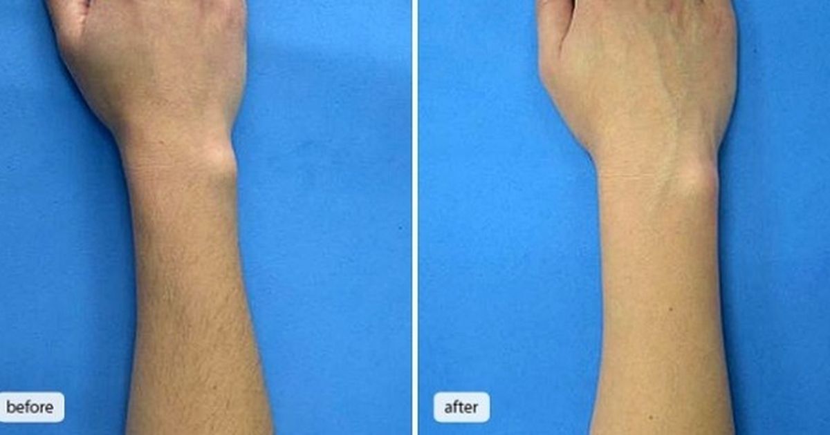 VIDEO Scapa de parul de pe maini fara sa folosesti lama sau ceara! Iata ...