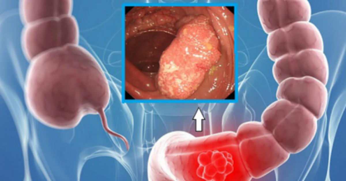 Stiai ca in colon se pot aduna 11 kilograme de reziduuri? Sursa bolilor ...