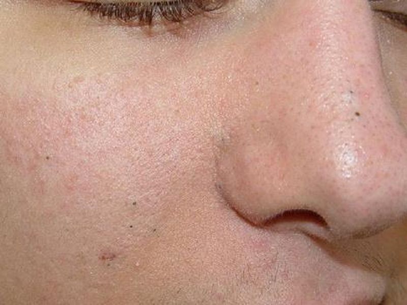 Remediu natural pentru pori incarcati si puncte negre! Ai nevoie de un ...