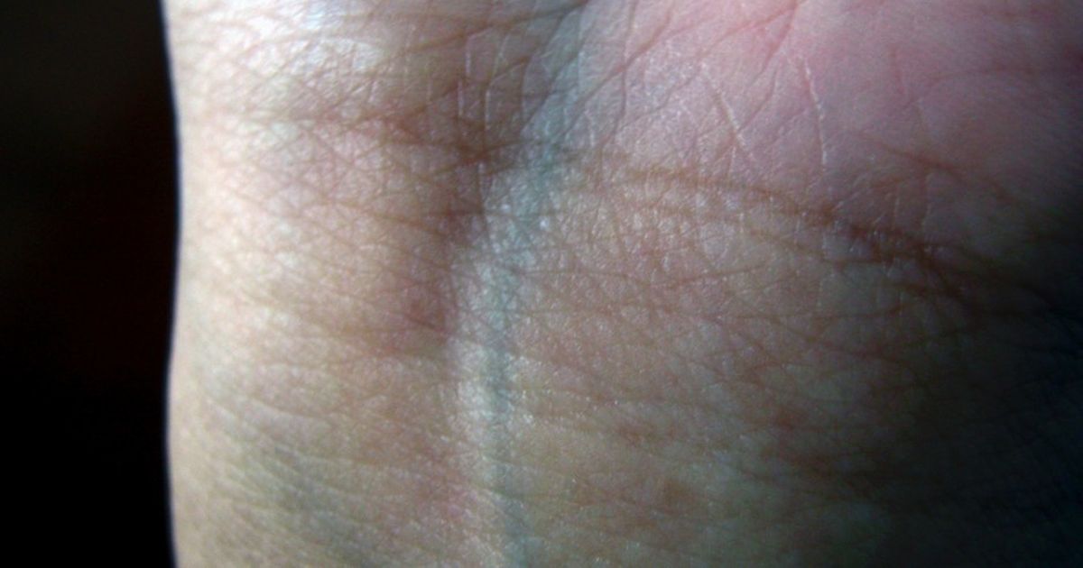 De ce sunt venele albastre - Kanal D Romania