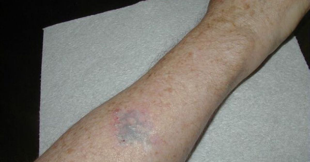 A vrut sa-si stearga un tatuaj, asa ca a cumparat o substanta ieftina ...