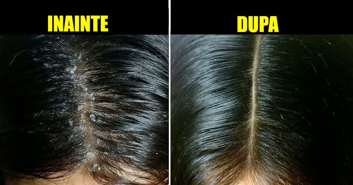 Cum sa scapi de matreata in doar 7 zile, fara sa dai bani pe sampoane ...