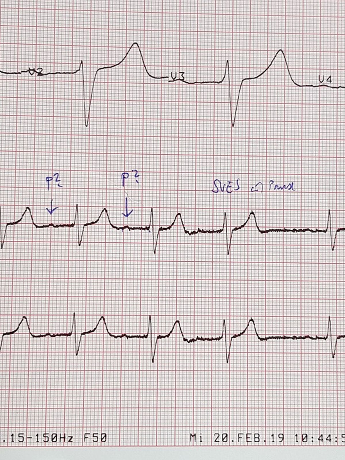 EKG-ul: ce este electrocardiograma si cand se recomanda? - Kanal D Romania