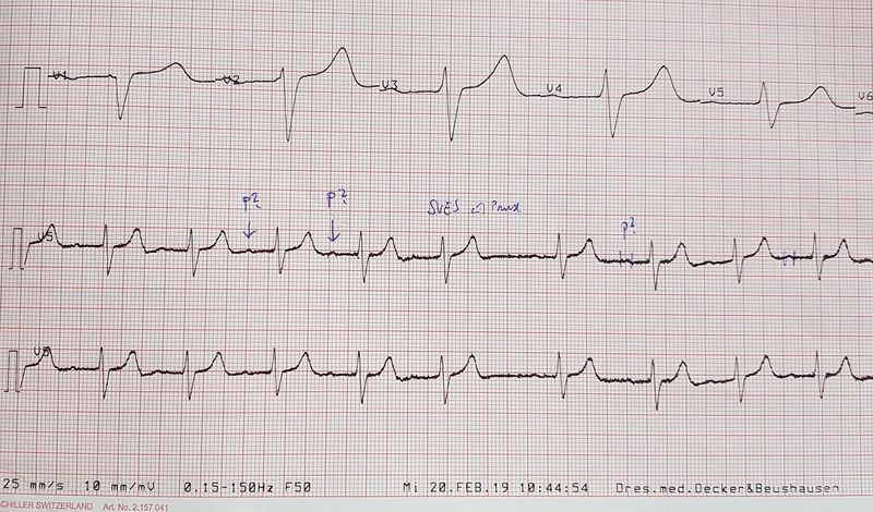 EKG-ul: ce este electrocardiograma si cand se recomanda? - Kanal D Romania