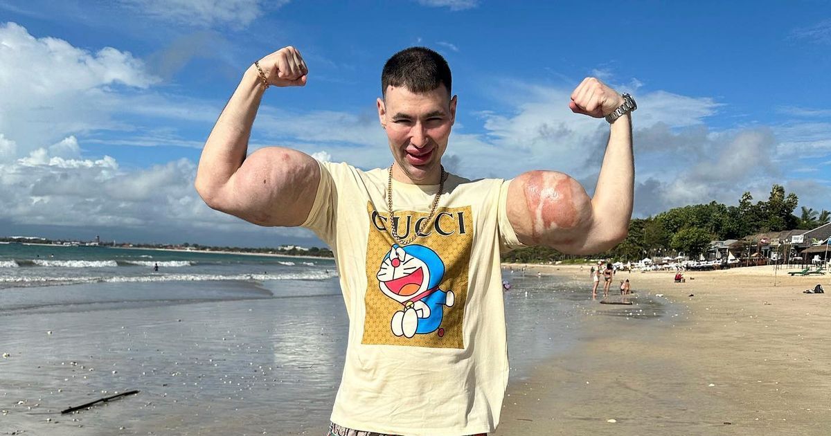 Celebrul Popeye din Rusia regretă că și-a injectat vaselină în bicepși ...