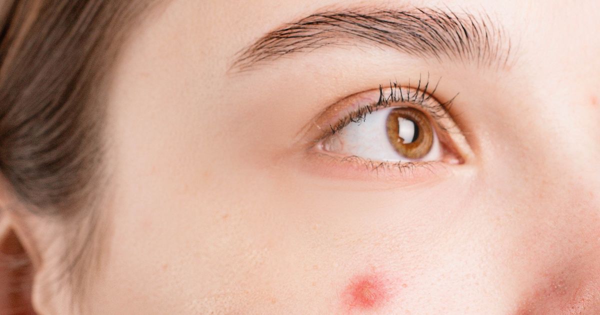 Cum îți dai seama că suferi de acnee. Este cea mai comună afecțiune a ...