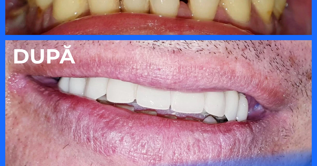 Implanturi asistate laser - KFetele